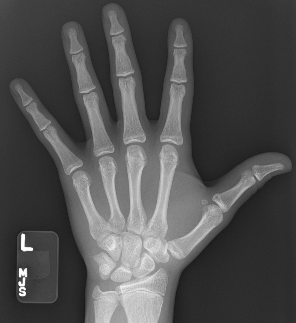 Does Accutane Stunt Growth in Kids and Teens? What Parents Should Know