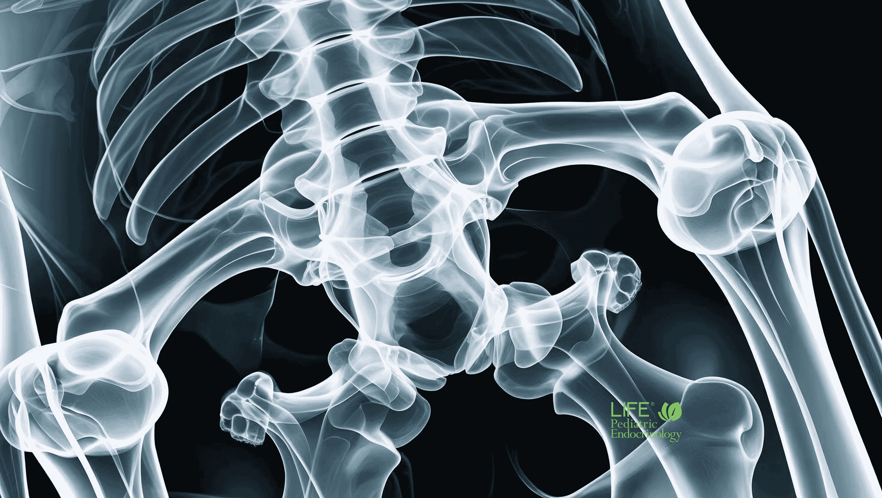 What Is Bone Disease? Understanding Causes, Symptoms, and Treatments