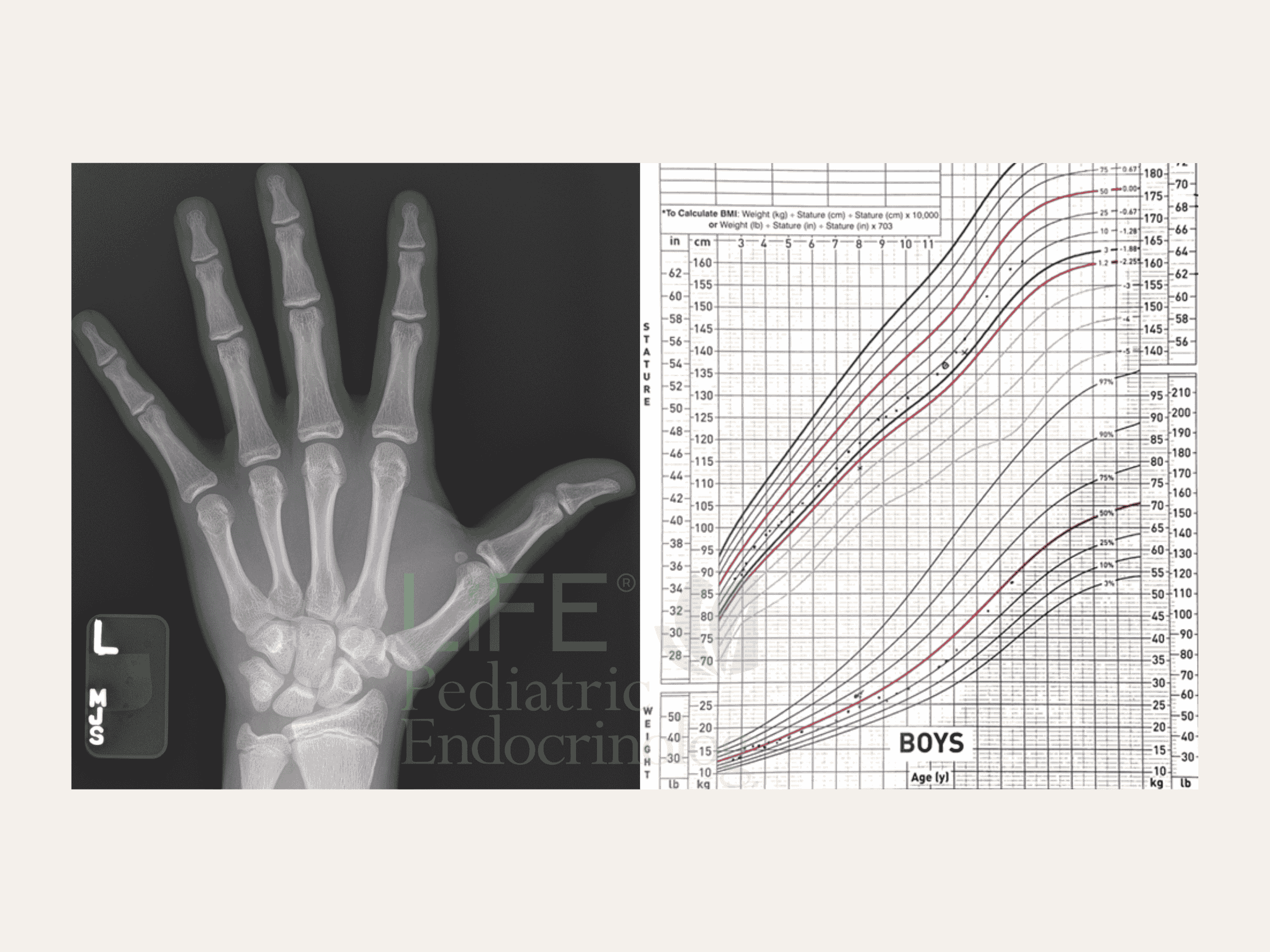 Weekly Growth Hormone Injections: Are They Right for Your Child?